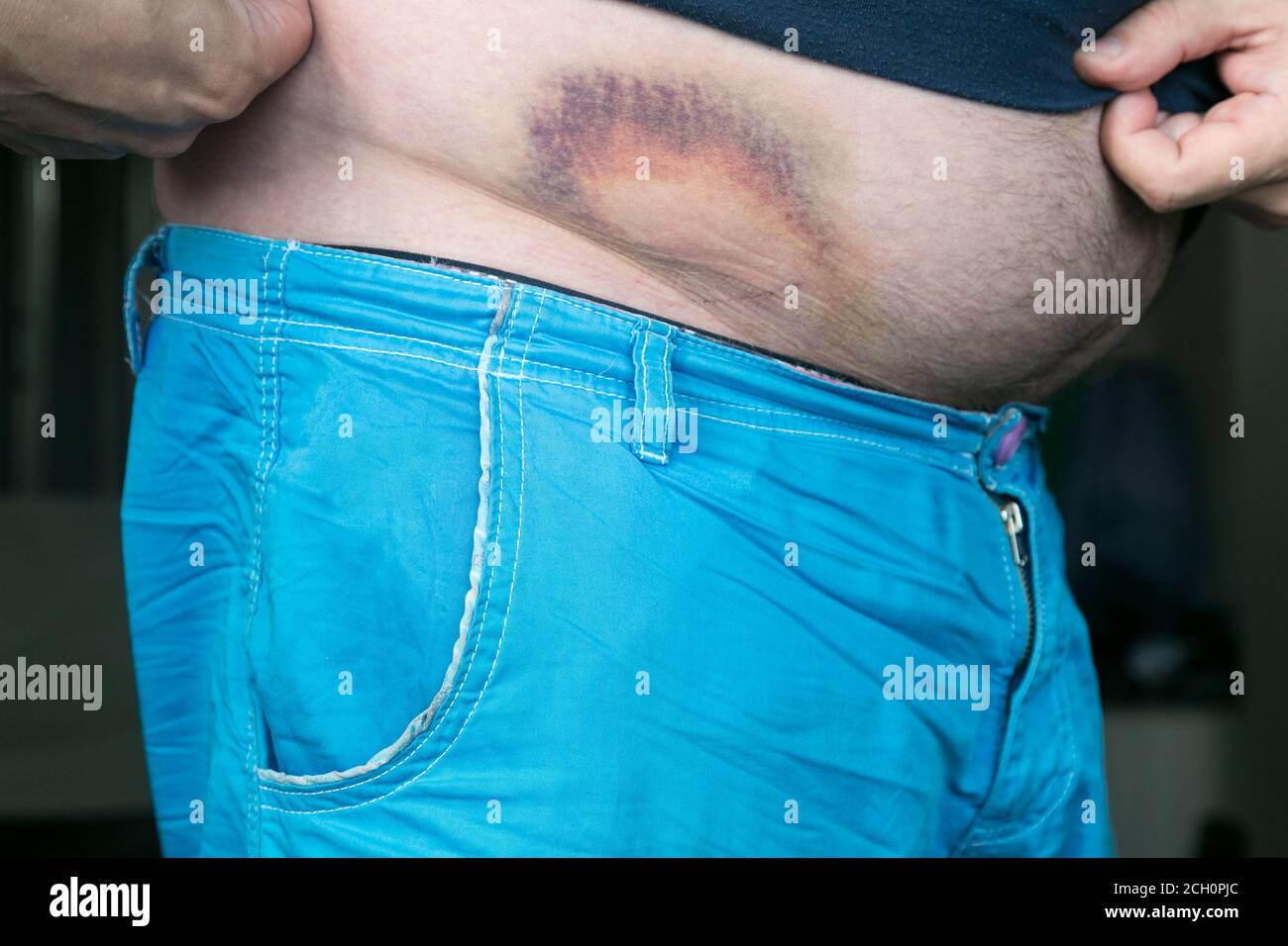 Abdominal Bruising