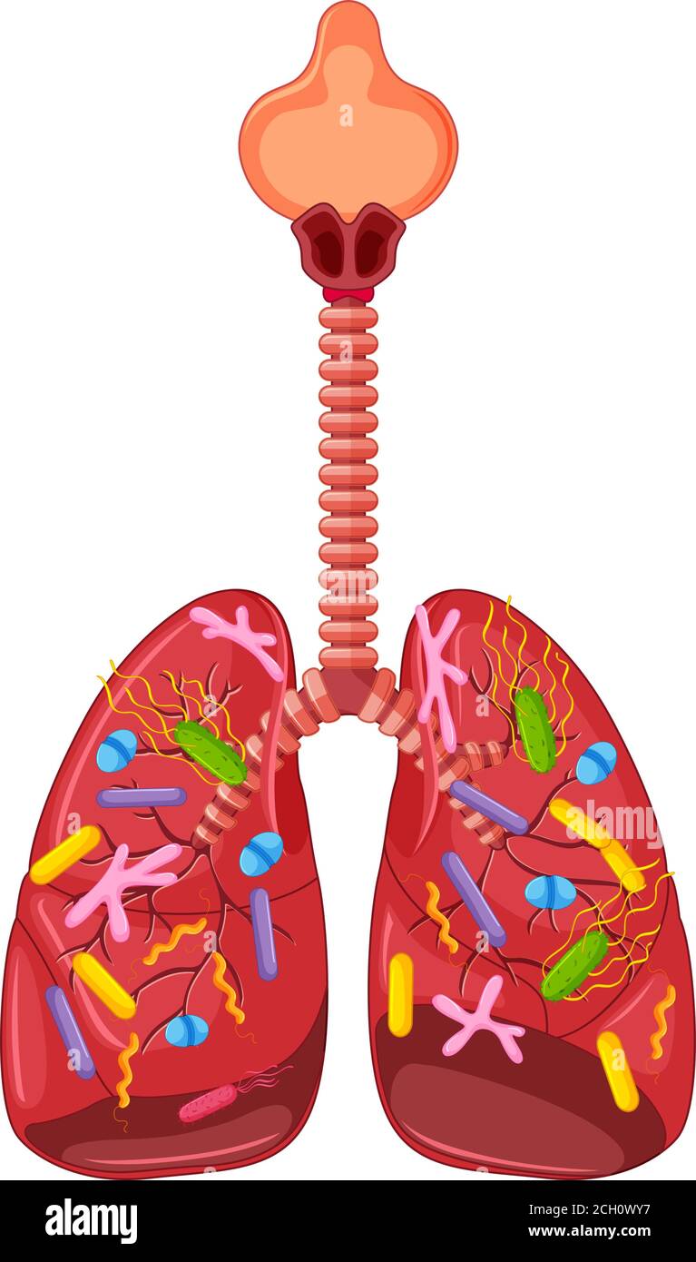 Bacterial lung infection anatomy illustration Stock Vector Image & Art ...