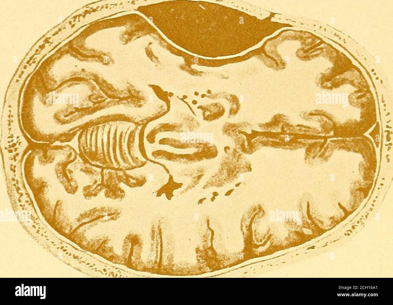 Subcutaneous hemorrhage hi-res stock photography and images - Alamy