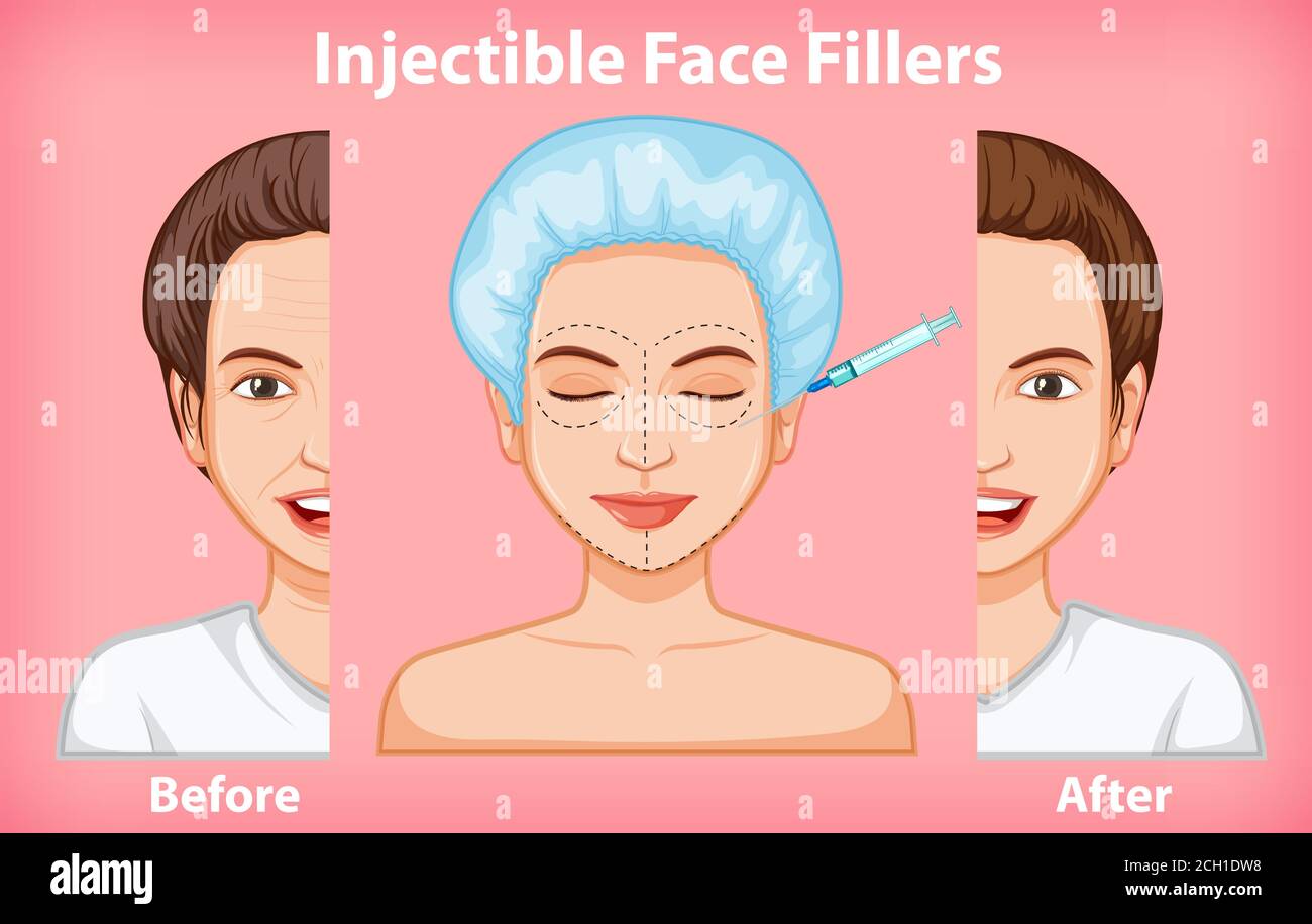 Different of face fillers before and after illustration Stock Vector ...