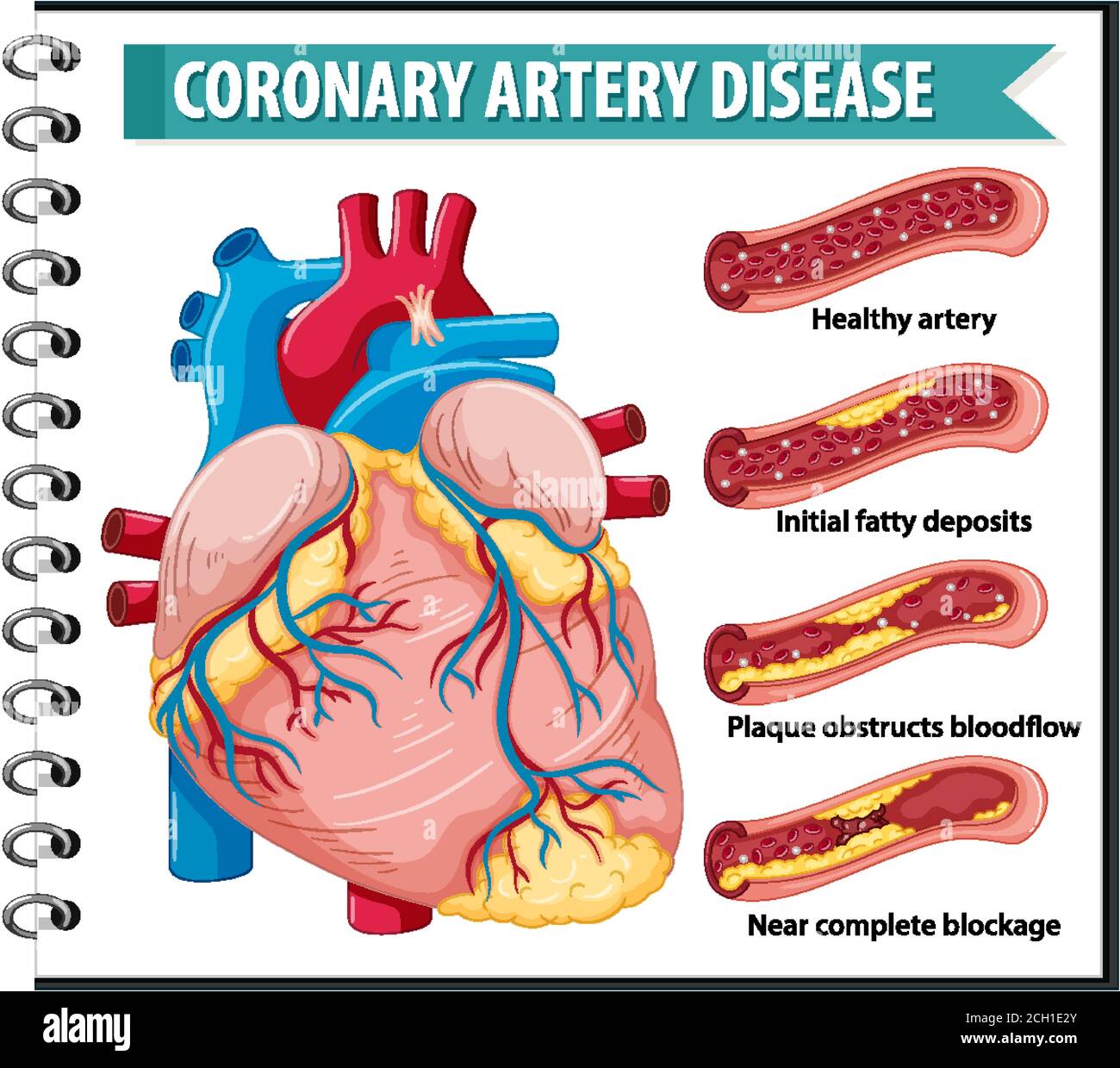 Coronary Heart Disease Poster Natural Color Laminated Paper Heart