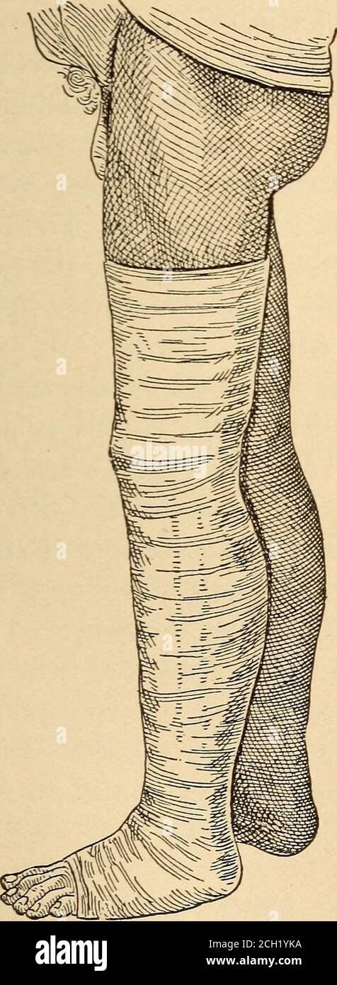 Rigid splints hi-res stock photography and images - Alamy