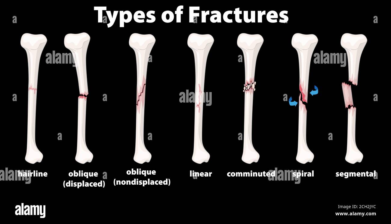 Type of Fractures diagram illustration Stock Vector Image & Art - Alamy