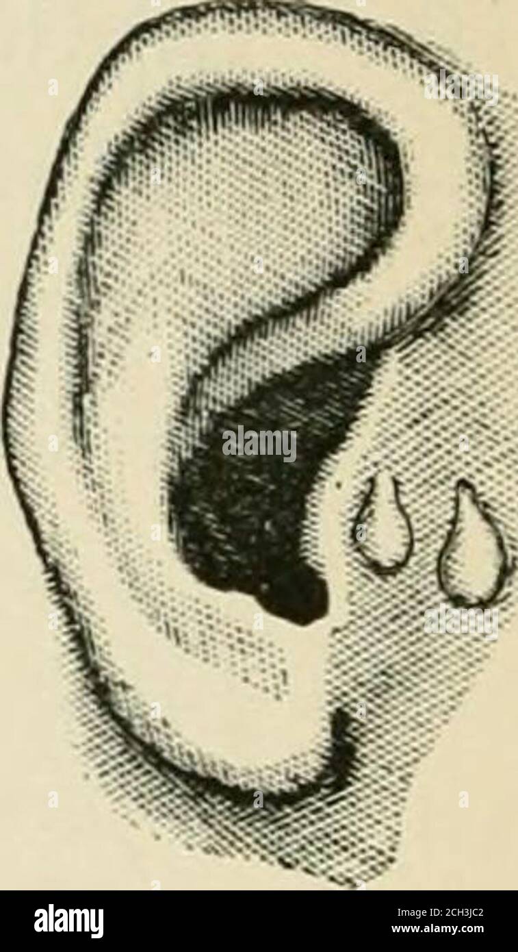. Evolution and disease . Fig. 95.—Human Ears with so-called ...