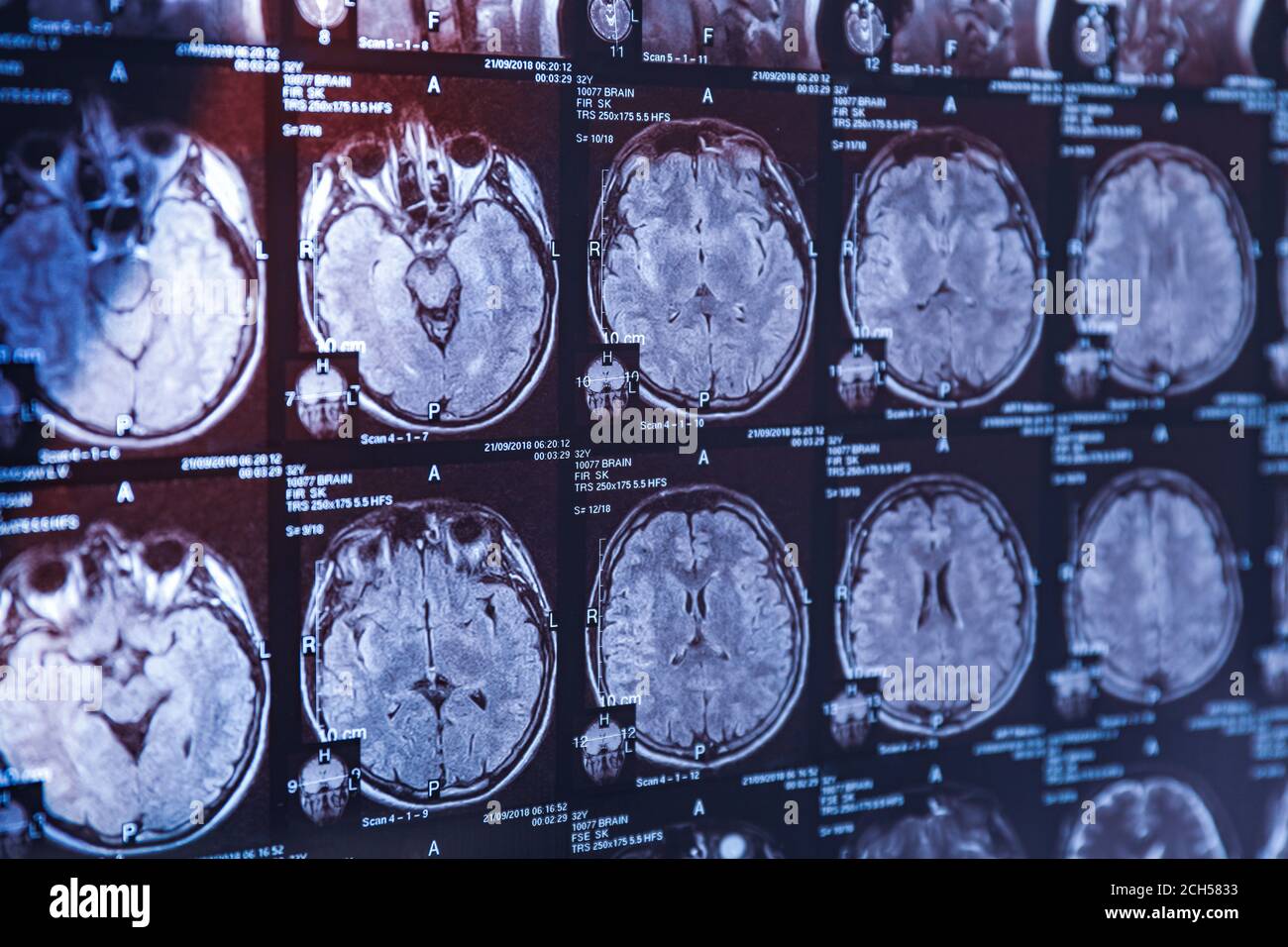 Parkinson disease mri hi-res stock photography and images - Alamy