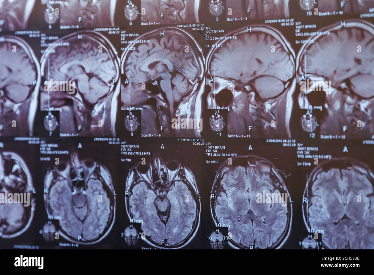 MRI scan of human head, closeup Stock Photo - Alamy