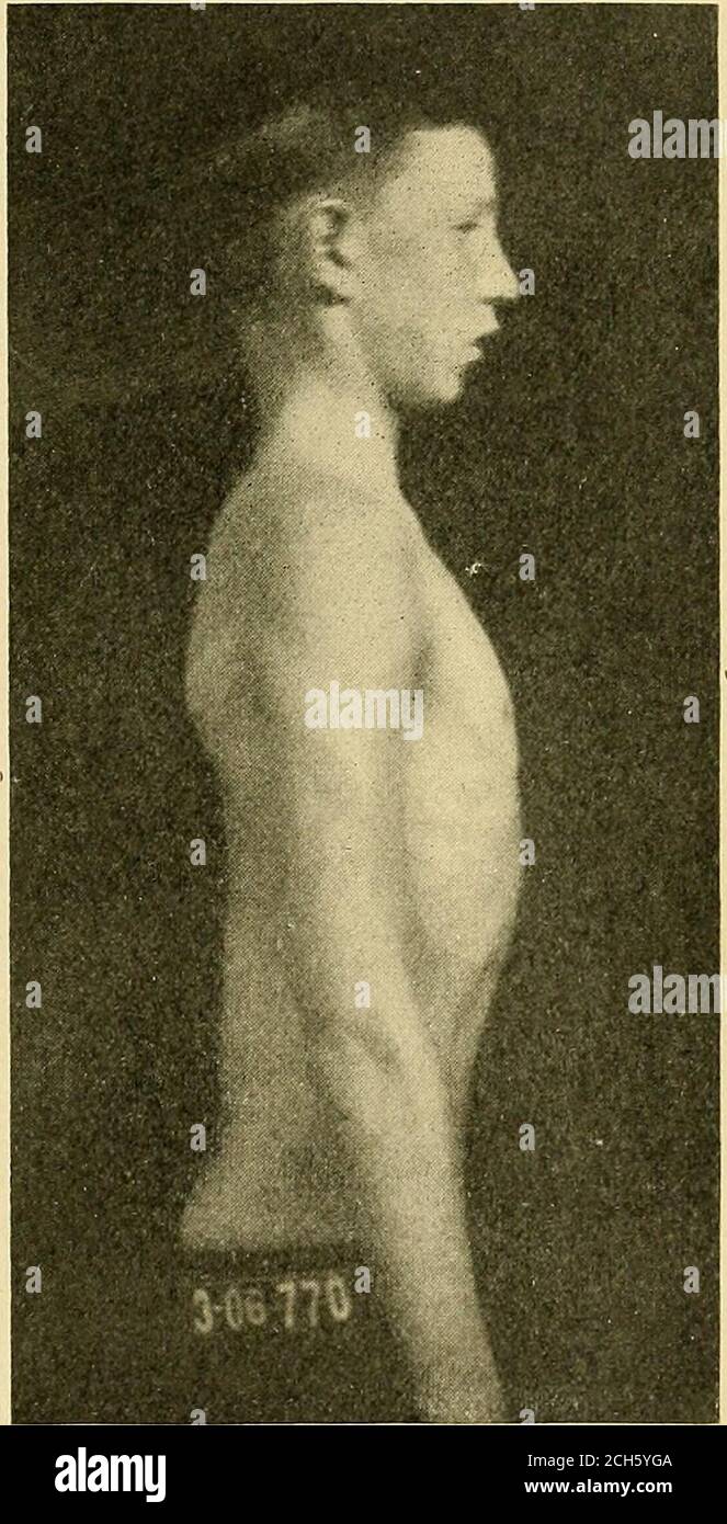 . Lateral curvature of the spine and round shoulders . FiG. 153.—Round ...