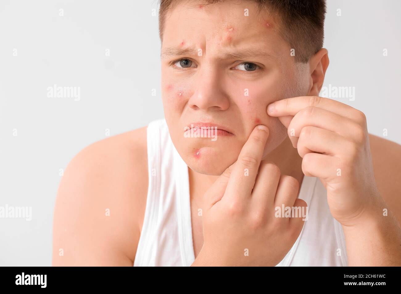 Teenage boy with acne problem squishing pimples on light background ...