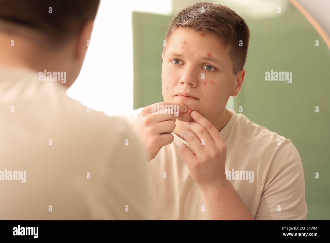 Teenage boy with acne squishing pimples near mirror Stock Photo - Alamy