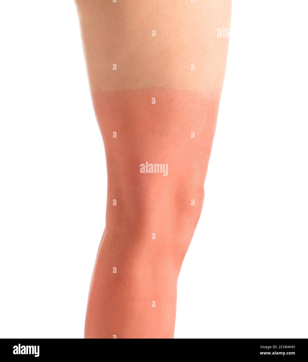 Woman With Red Sunburned Skin On Leg Against White Background Stock