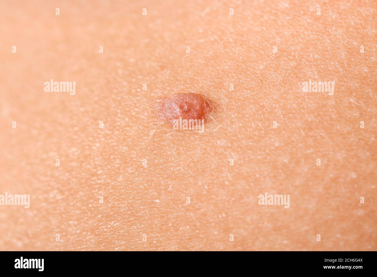 Human skin with mole, closeup Stock Photo - Alamy