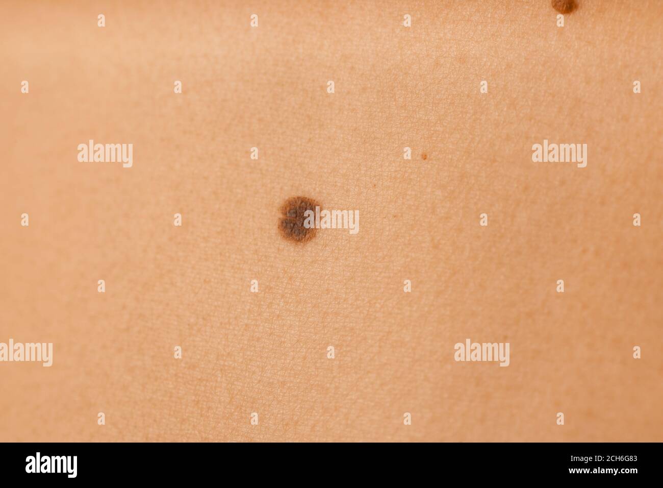 Human skin with moles, closeup Stock Photo - Alamy