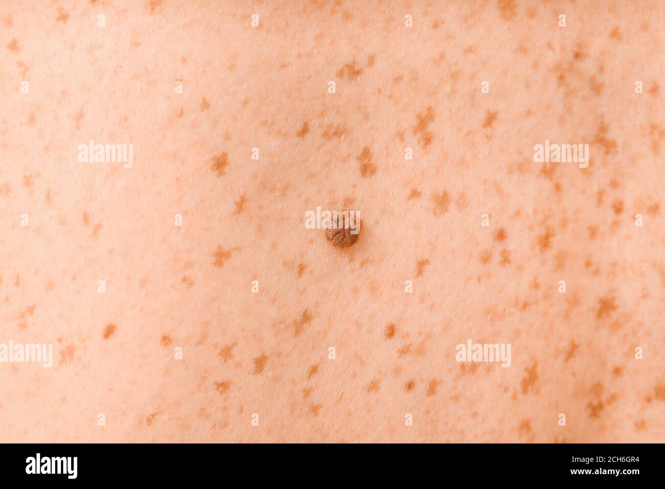 Human skin with moles, closeup Stock Photo - Alamy