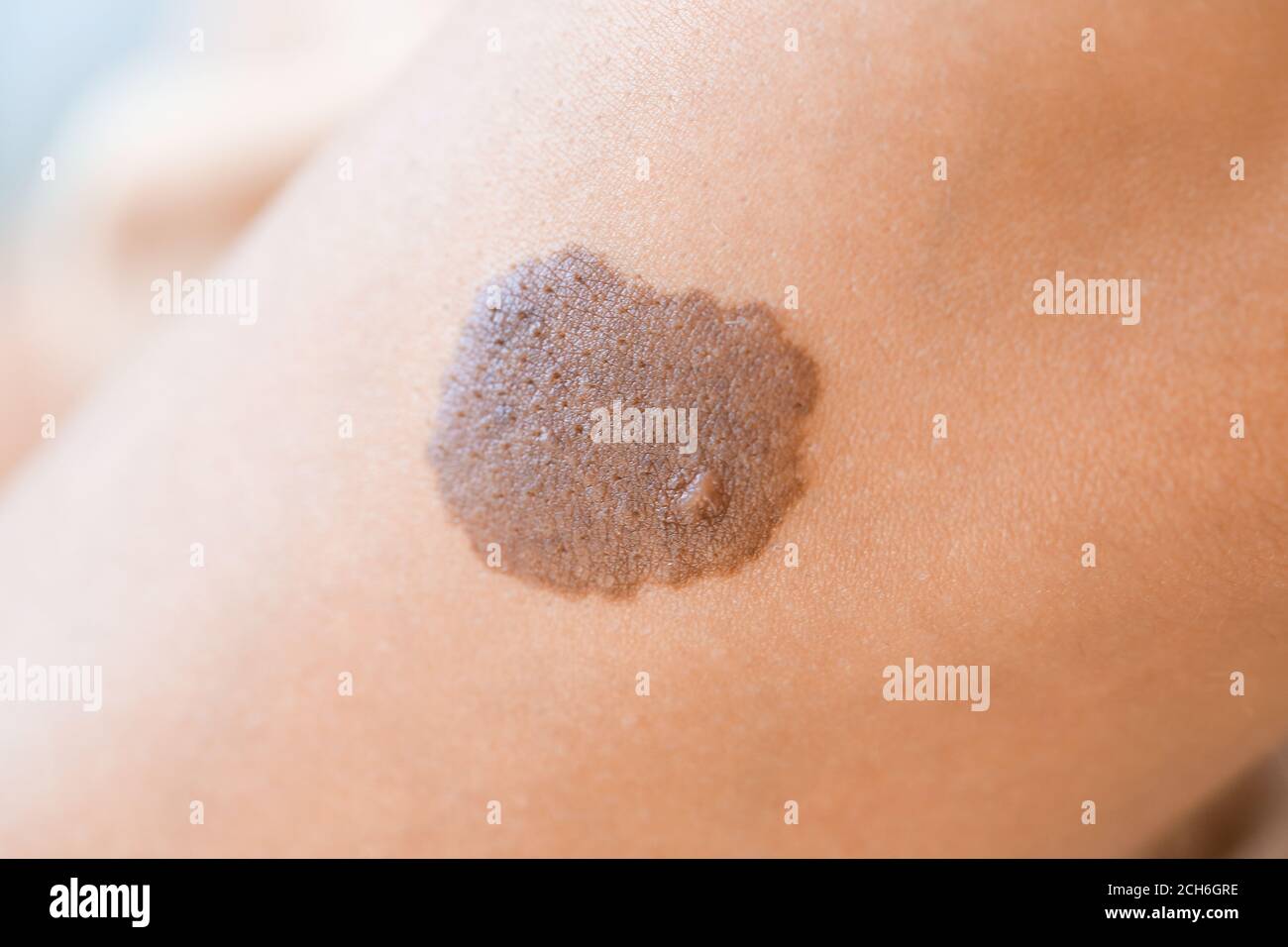 Birthmark on human skin, closeup Stock Photo - Alamy