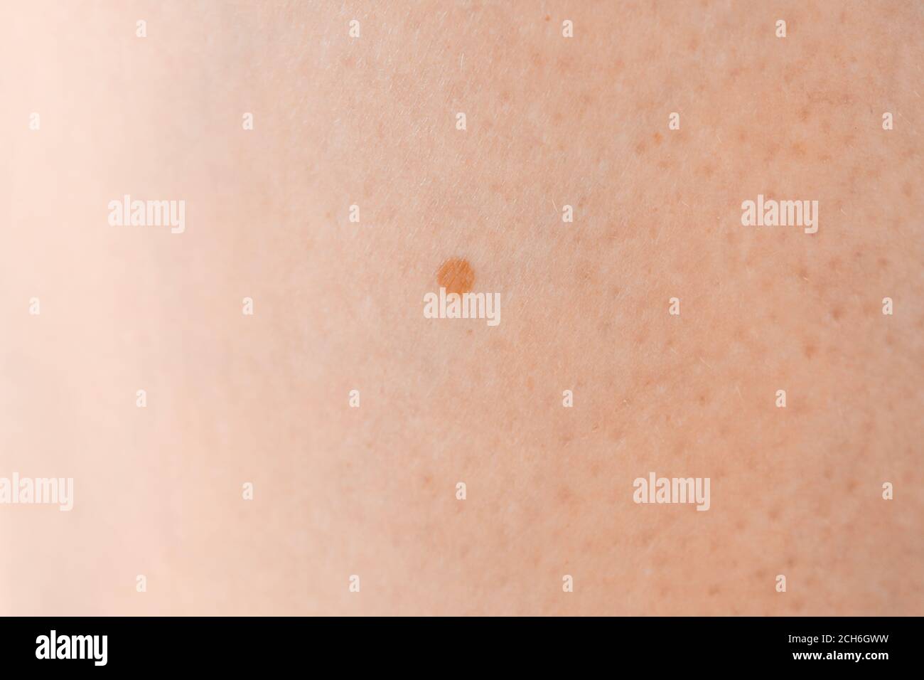 Human skin with mole, closeup Stock Photo - Alamy