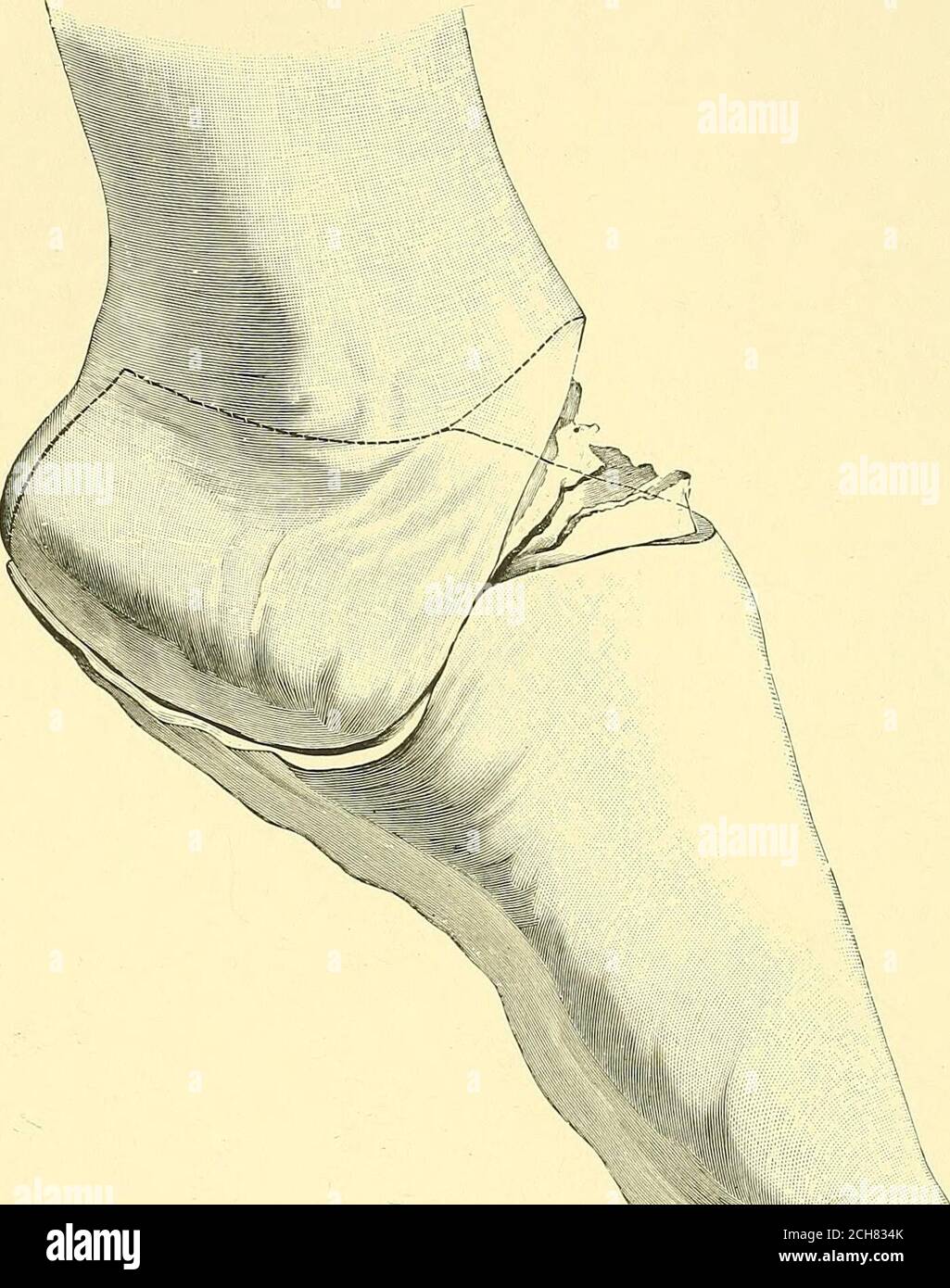 . Text-book of operative surgery . er, J. Bell nsed an internal heel ...