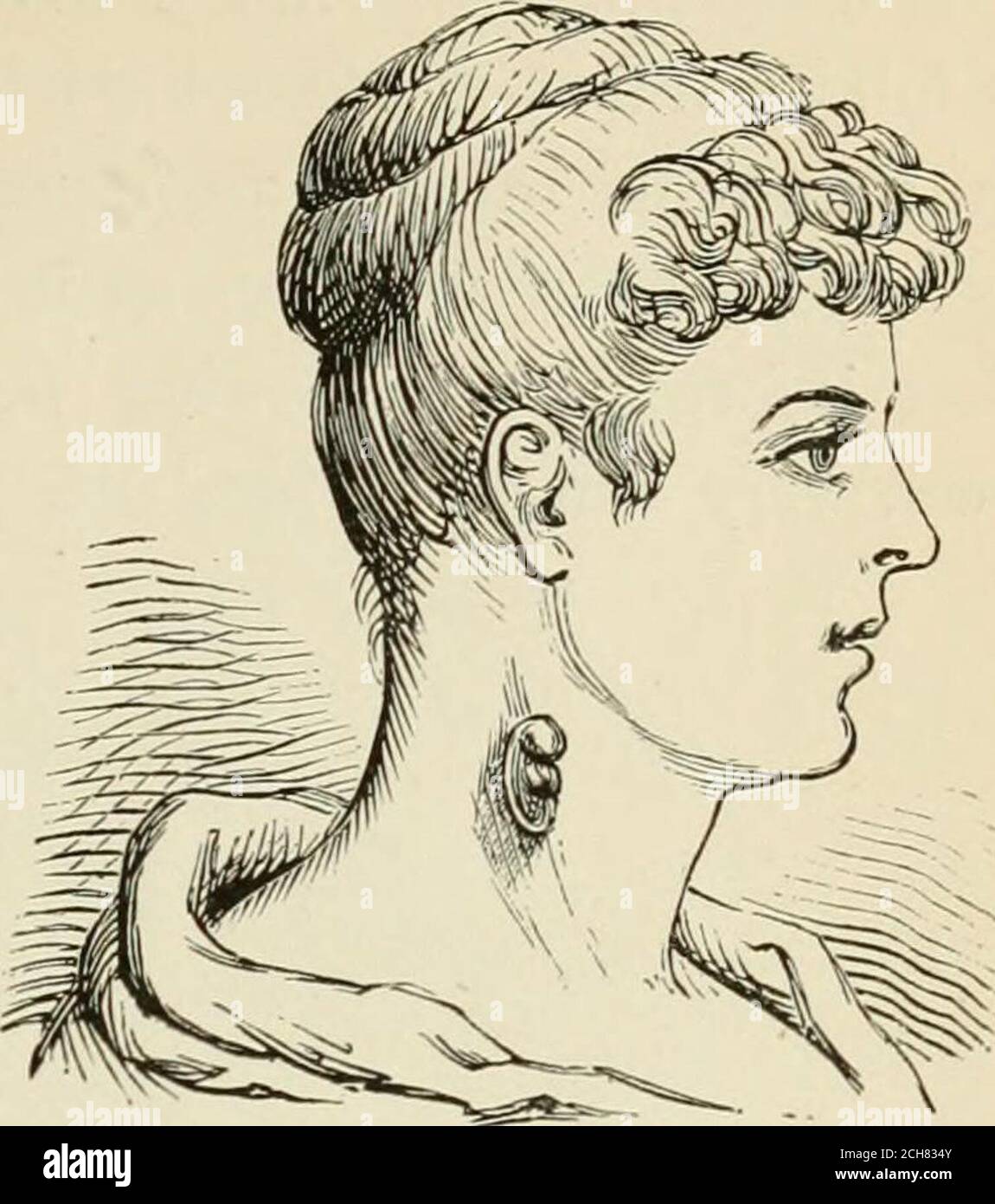 Skin tag neck hi-res stock photography and images - Alamy