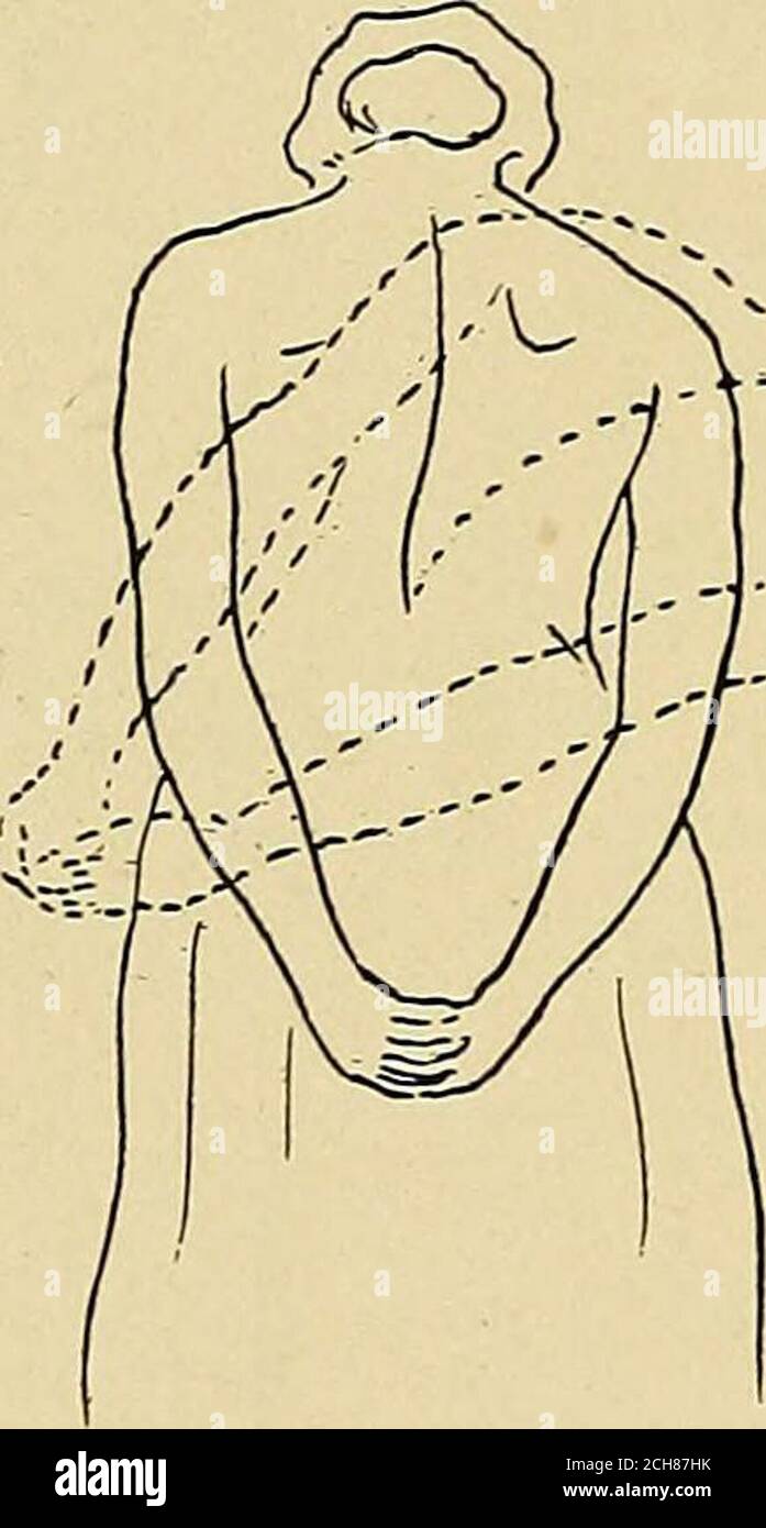 . Lateral curvature of the spine and round shoulders . 140 TREATMENT ...