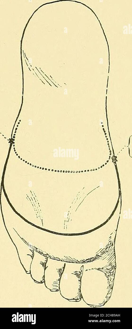 . Text-book of operative surgery . Tub. 5tlameta-tarsal.. Base of. Ist ...