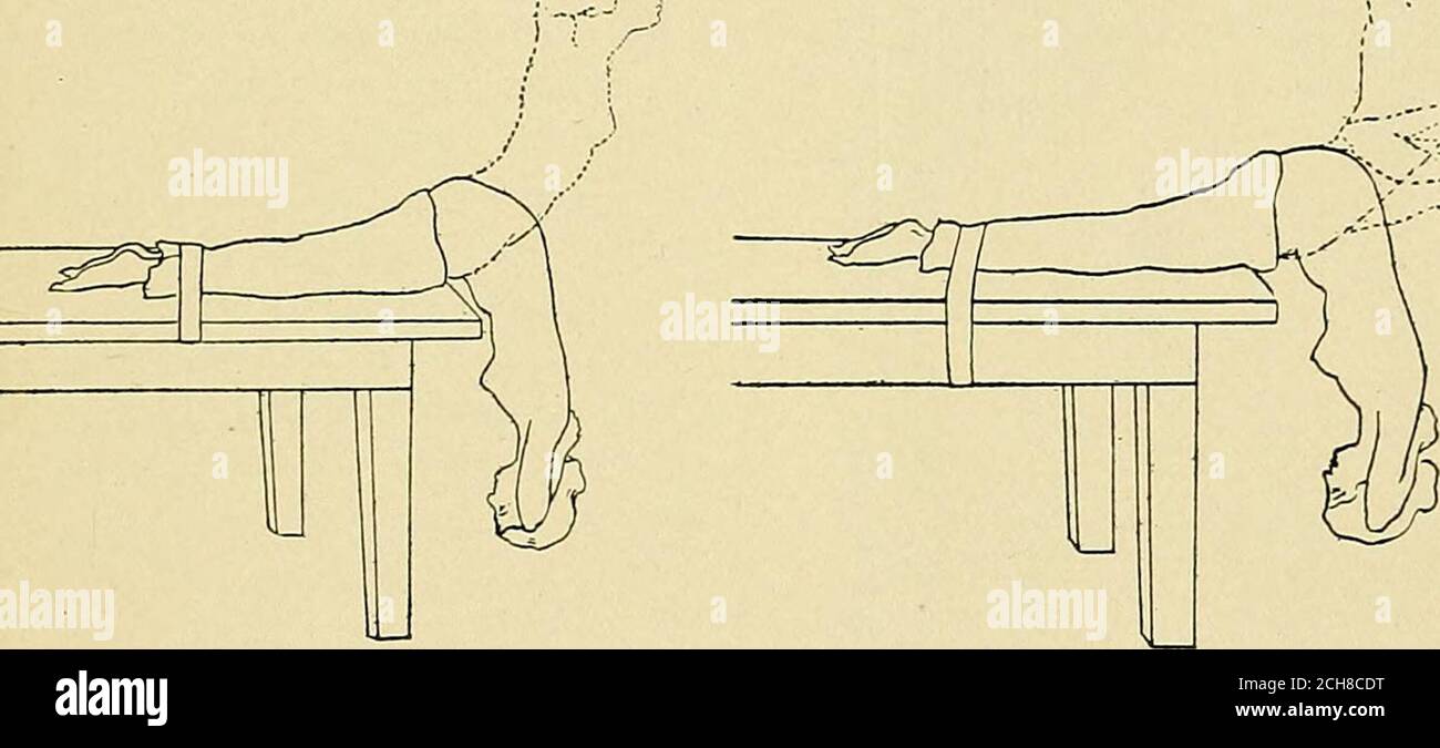 . Lateral curvature of the spine and round shoulders . Staff is brought ...