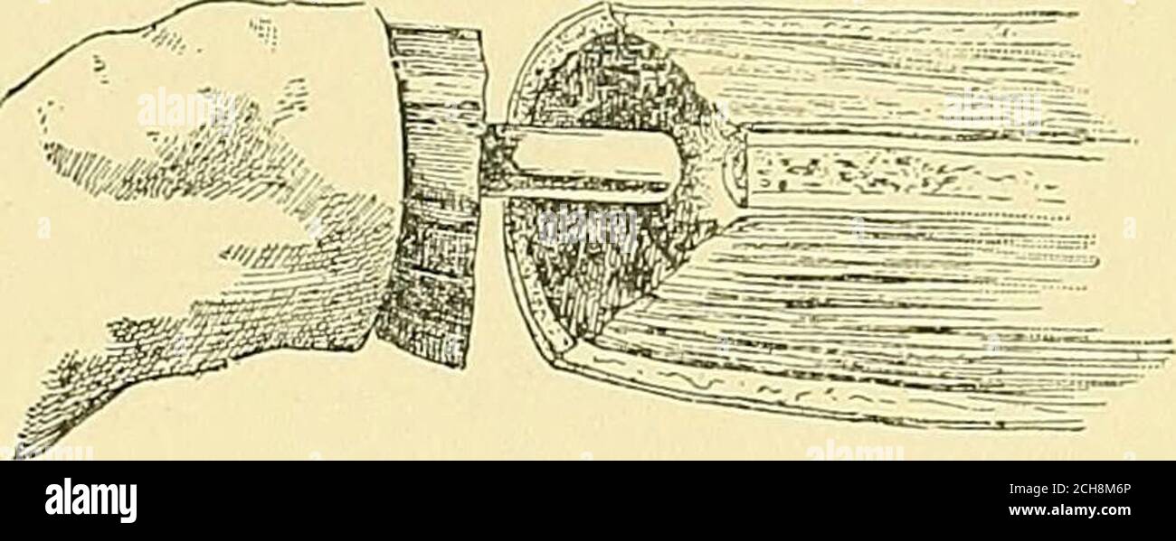 . Text-book of operative surgery . Fig. 195.—Transverse circiilar ...