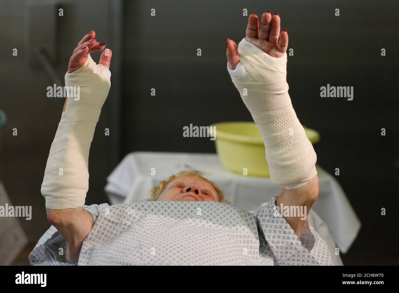 Both Arms Casts High Resolution Stock Photography and Images - Alamy