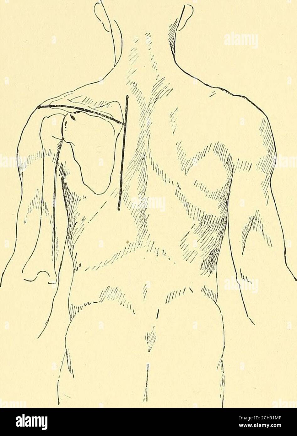 . Text-book of operative surgery . the whole acromion is to be removed ...