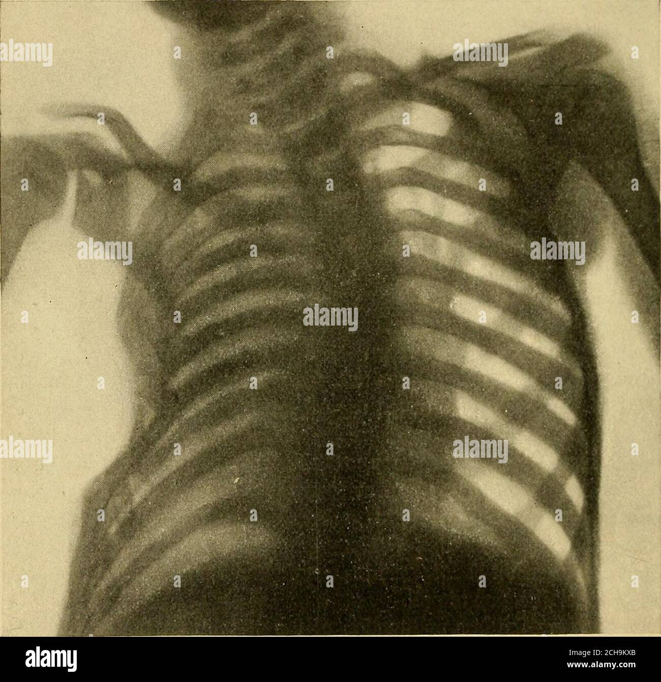 . Lateral curvature of the spine and round shoulders . e to its ...