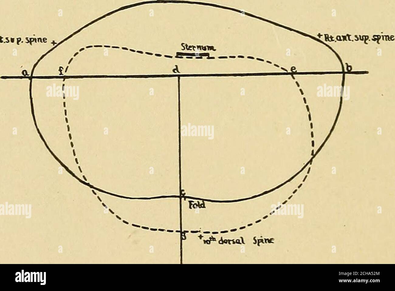. Lateral curvature of the spine and round shoulders . A light from ...