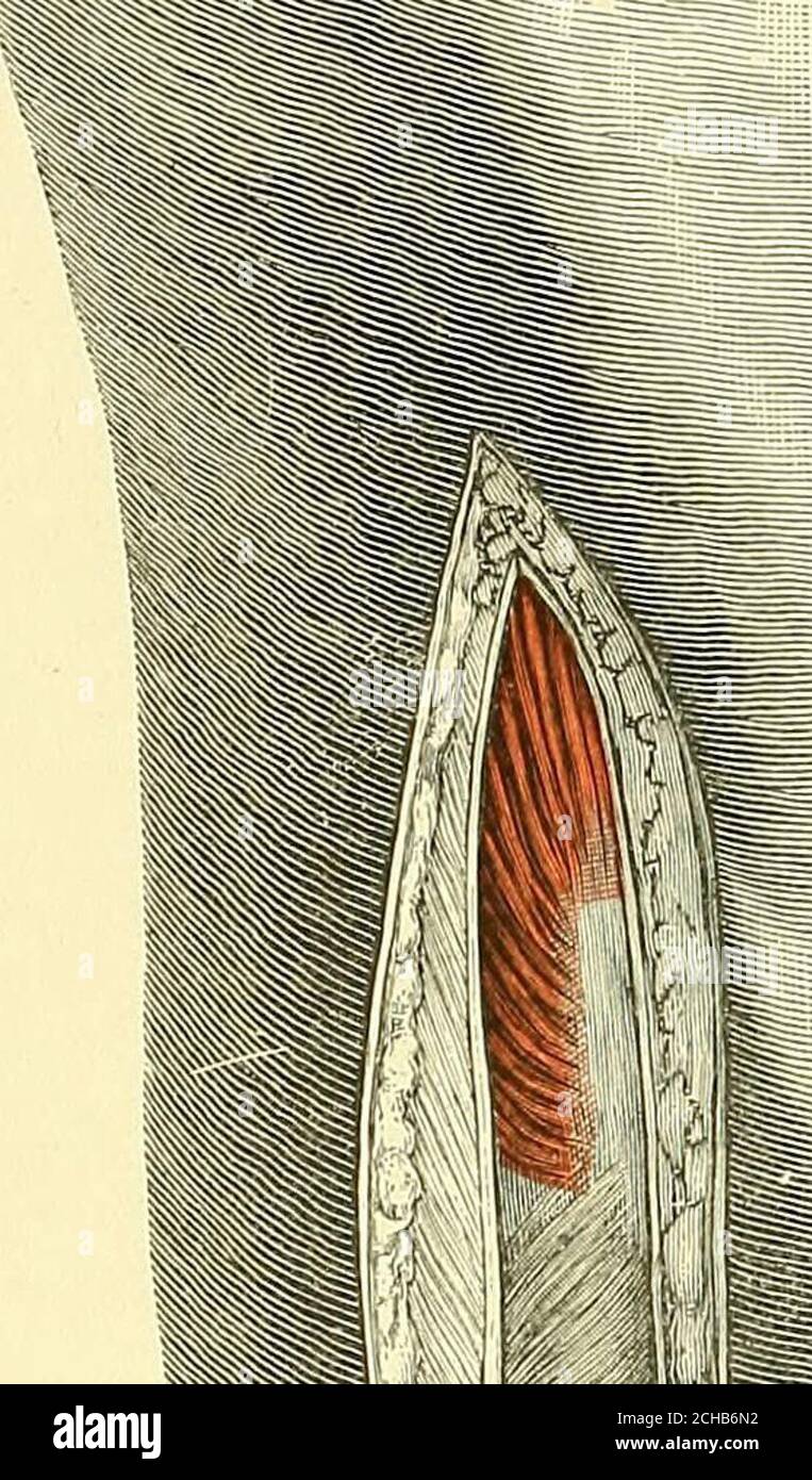 . Text-book of operative surgery . 157.—-Incision for artlirotomy of ...