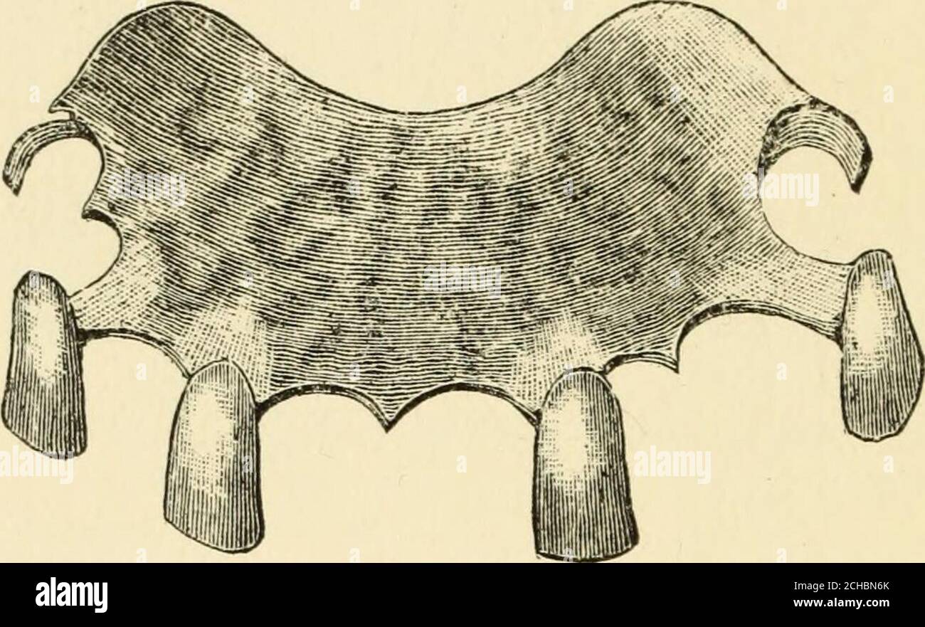 . The teeth in health and disease . Fig. 84: Fig. 84 illustrates a case ...