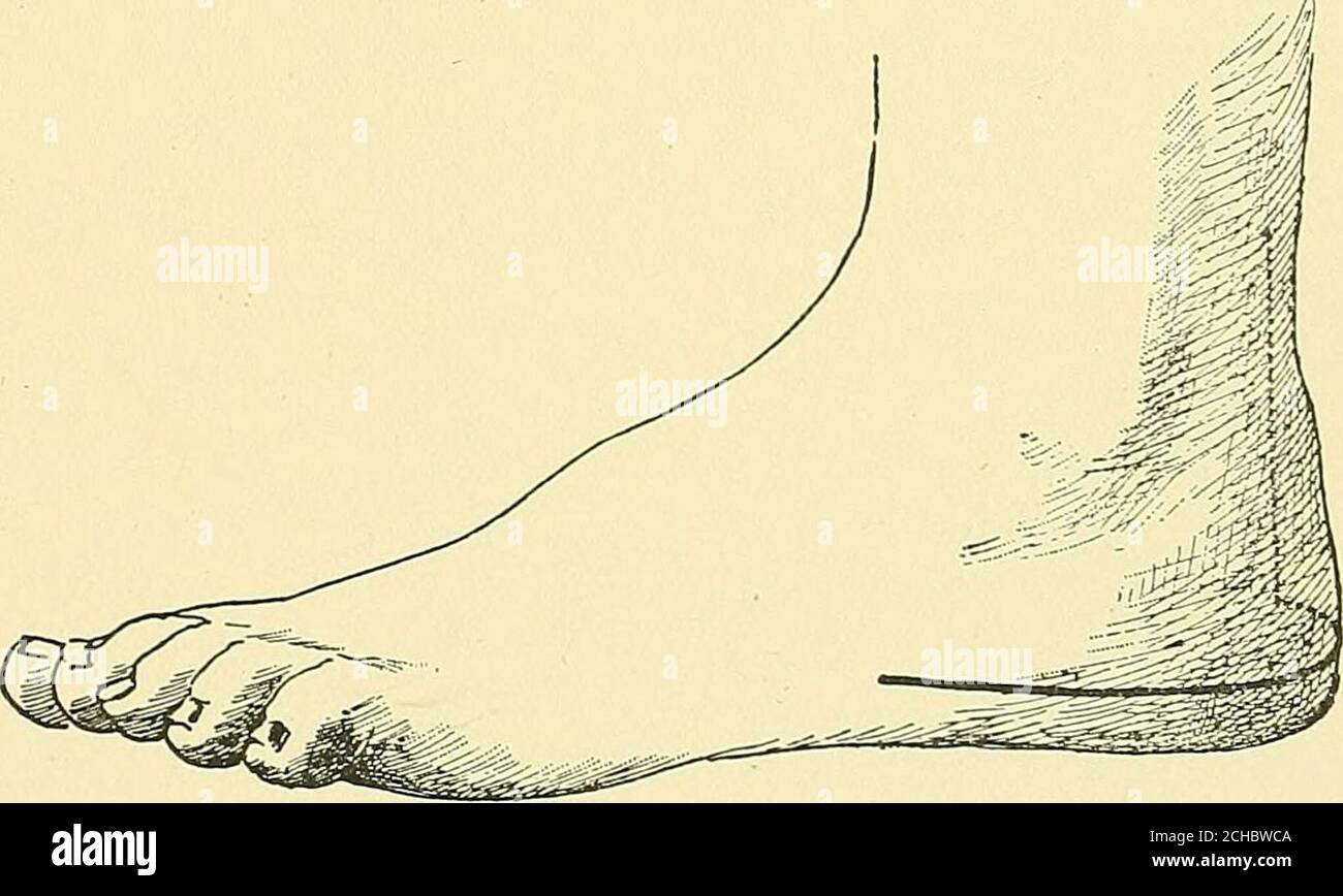 Calcaneo posterior hi-res stock photography and images - Alamy