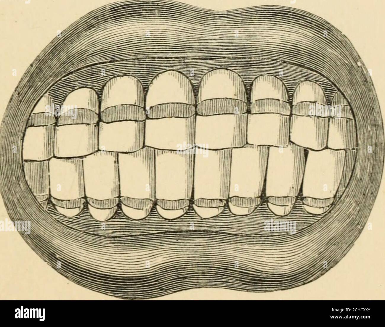 . The teeth in health and disease . Fig. 65. caries, as during the ...