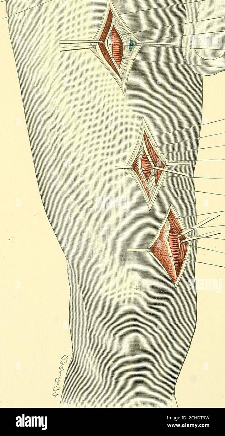 . Text-book of operative surgery . (2) Ilio-psoas m Ant. crural n ...