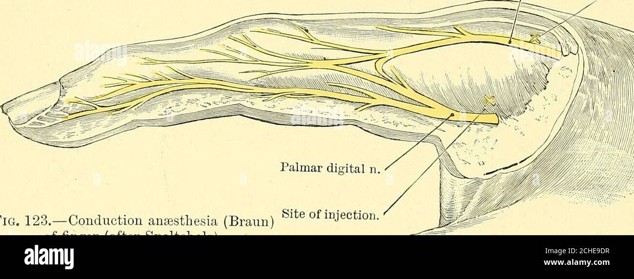 . Text-book of operative surgery . tlie palm the branches of the median ...