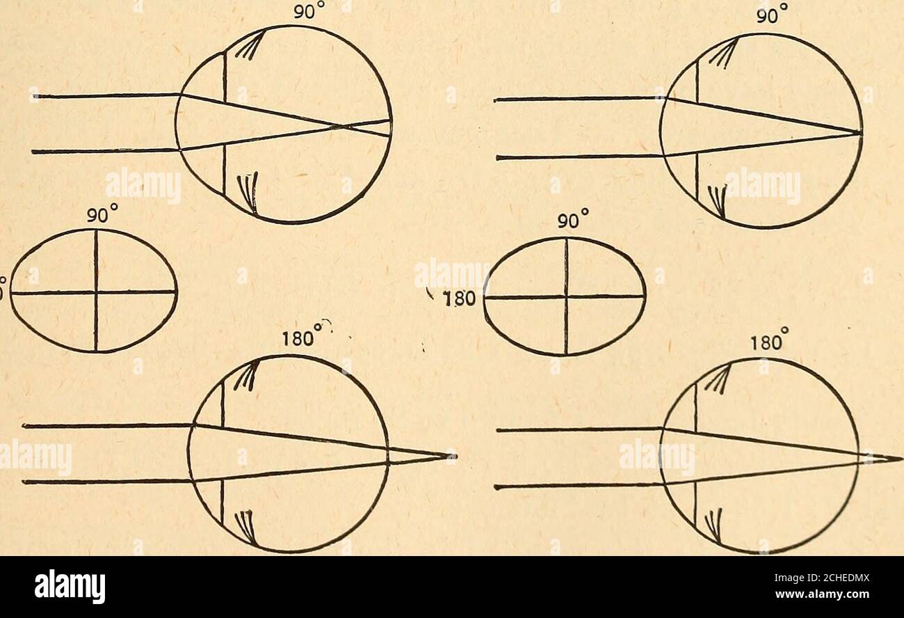 Spasm of accommodation hi-res stock photography and images - Alamy
