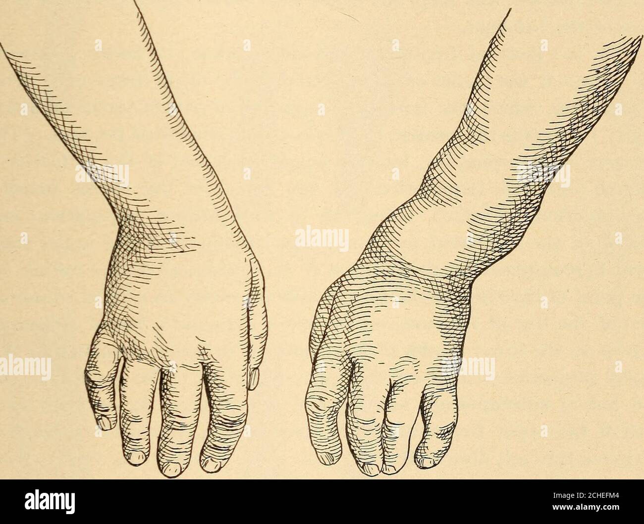 Supination And Pronation Of Forearm