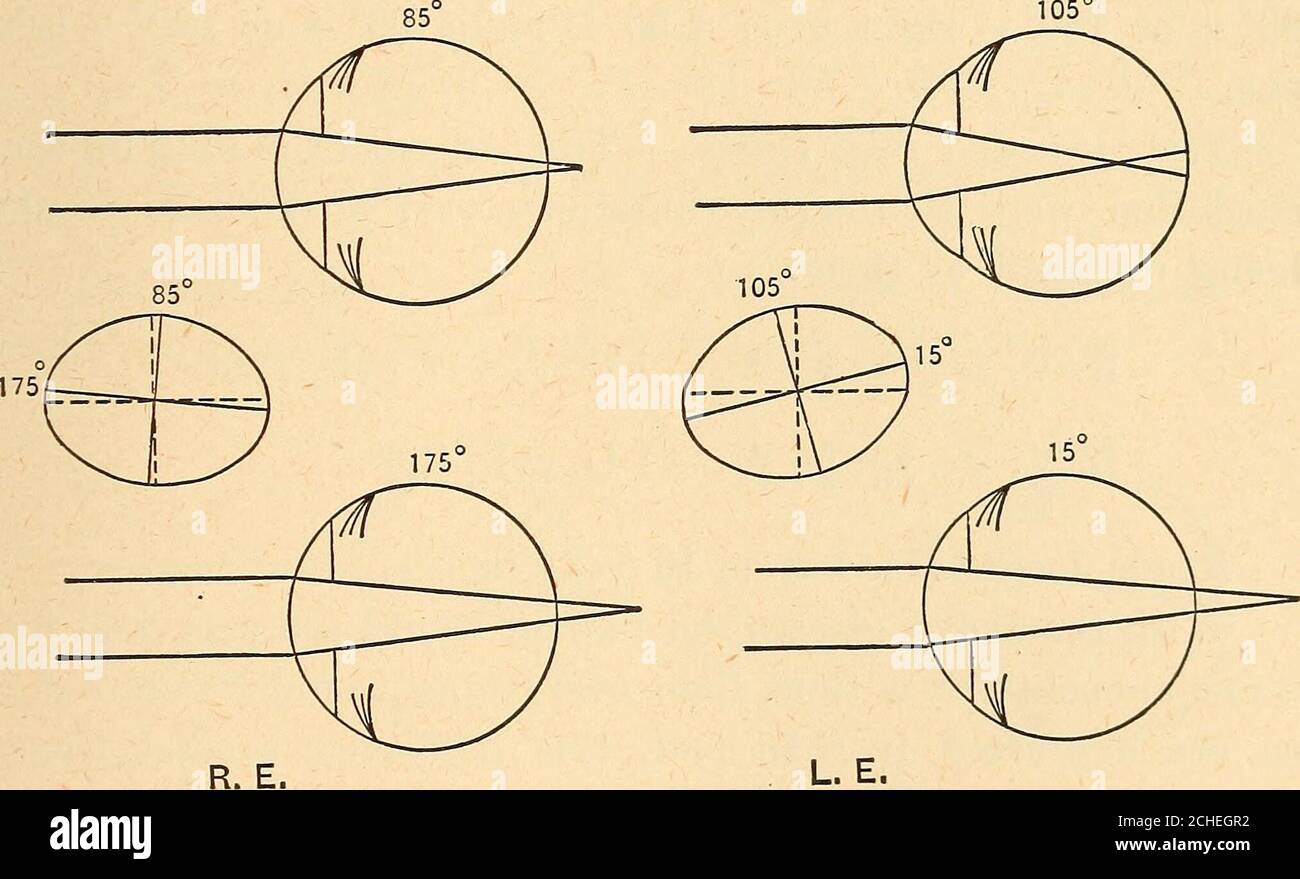 . The refraction of the eye; including a complete treatise on ...