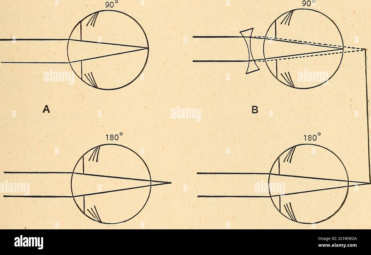 Hypermetropic High Resolution Stock Photography and Images - Alamy