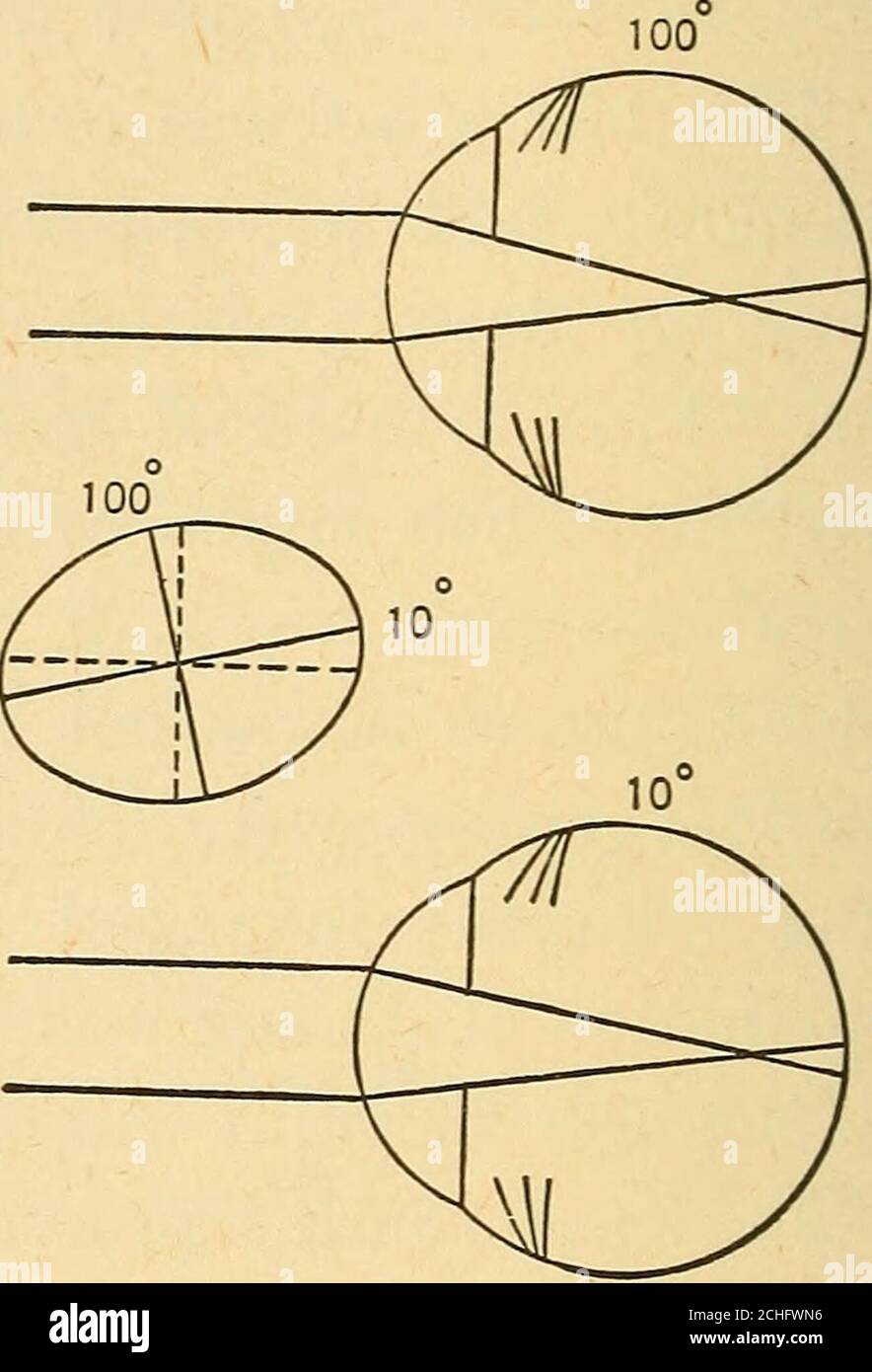Compound myopic astigmatism hi-res stock photography and images - Alamy