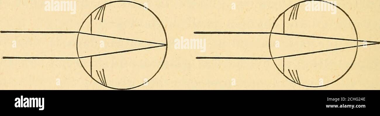 . The refraction of the eye; including a complete treatise on ...