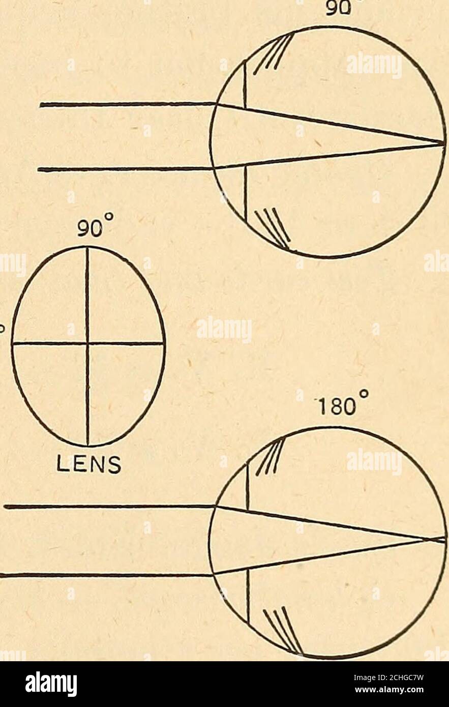Subjective refraction hi-res stock photography and images - Alamy