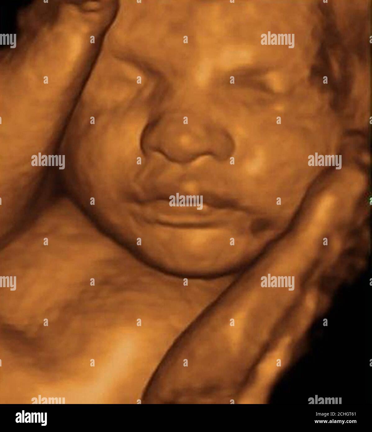 Portland Hospital undated jandout photo of a 4D scan of a baby ...