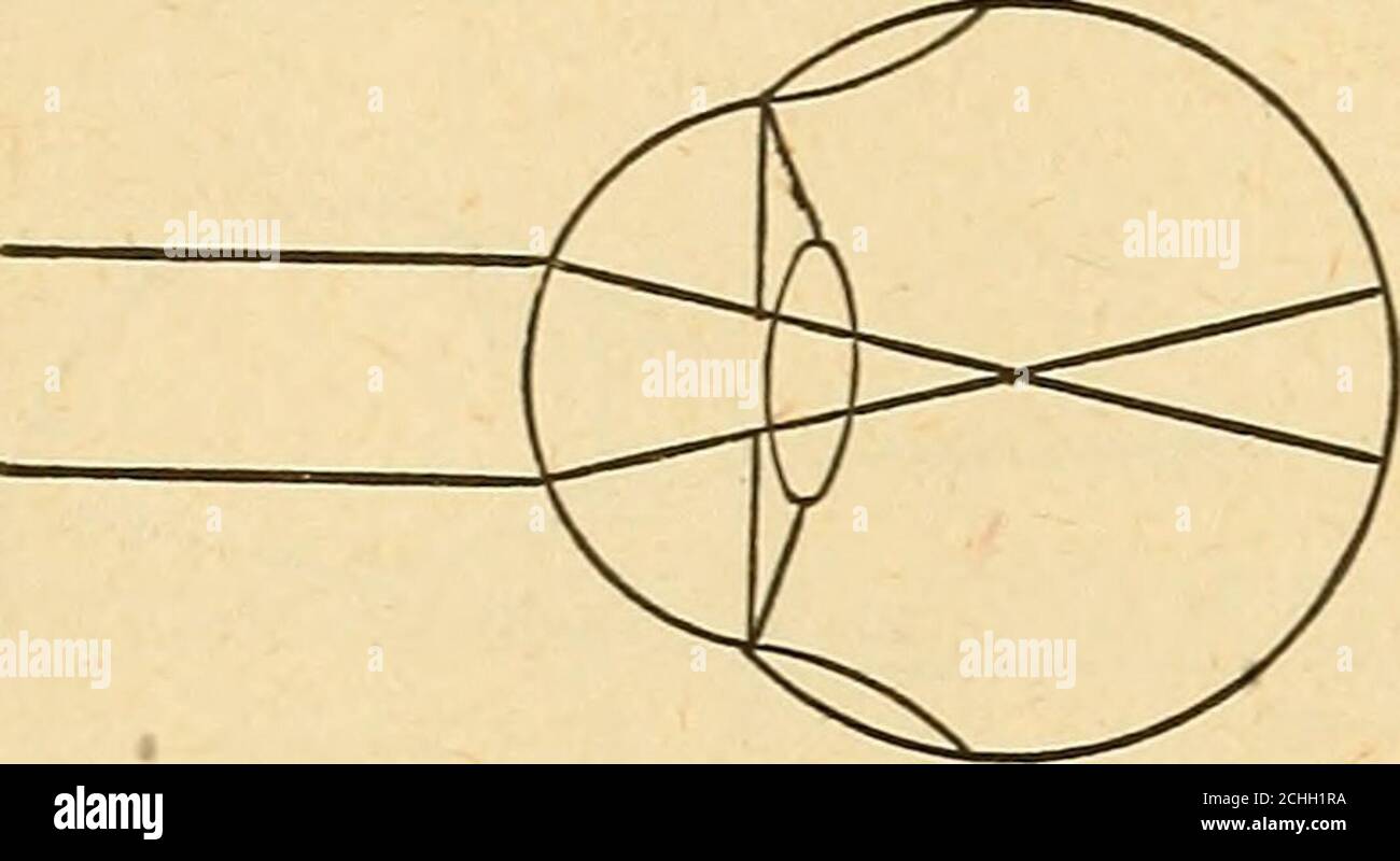 Refraction eye including complete treatise hi-res stock photography and ...