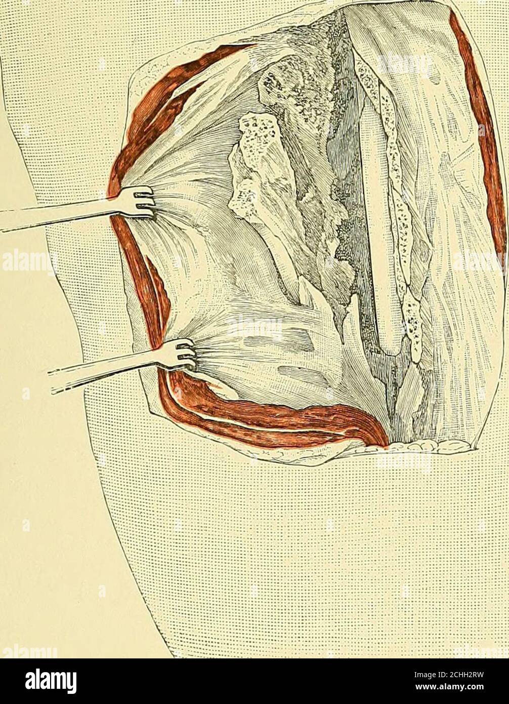 Operative chirurgie 1905 hi-res stock photography and images - Alamy
