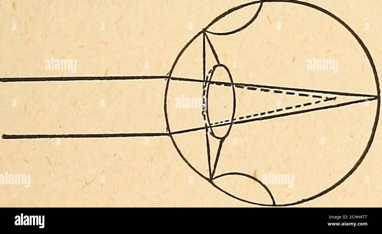 Spasm of accommodation hi-res stock photography and images - Alamy