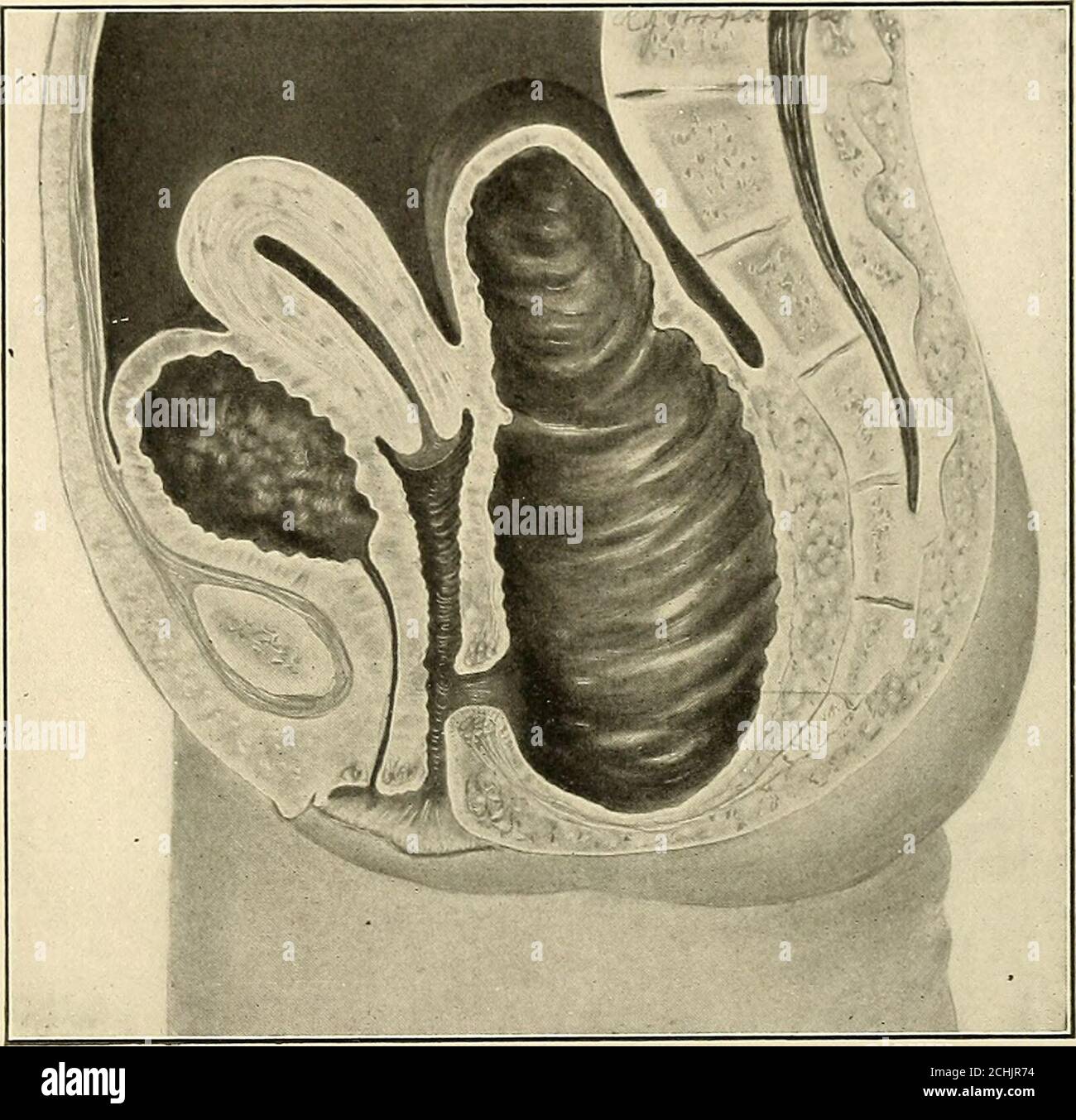 Pelvic floor surgery hi-res stock photography and images - Alamy