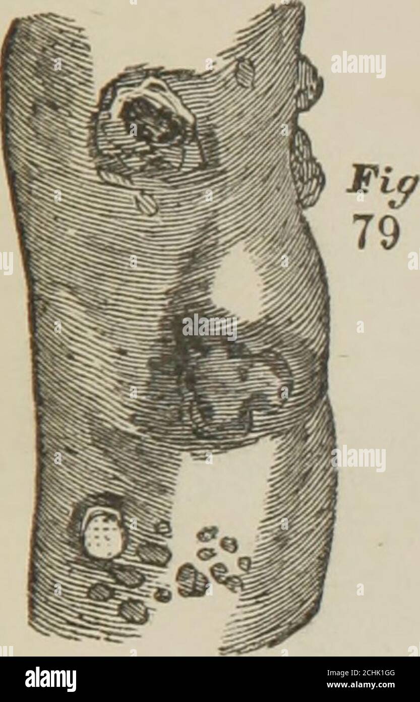 Primary syphilis hi-res stock photography and images - Alamy