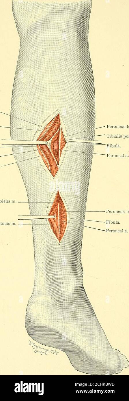 . Text-book of operative surgery . (3) Fascia lata. Edge of soleus m ...