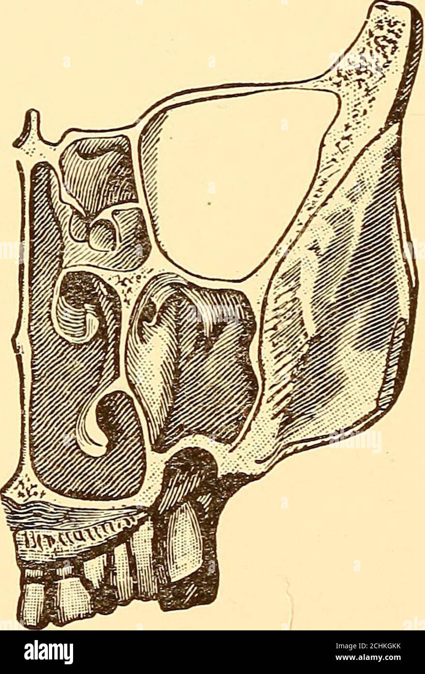 . Diseases of the nose and throat . Fig. 14.—Diagram showing ...